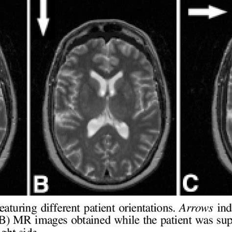 Brain Shift Results Of Intraoperative Imaging And Fe Model Download Table