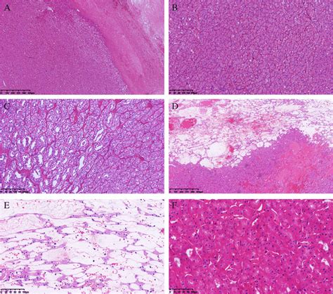 Representative Microscopic Features Of Low Grade Oncocytic Tumor A The Download Scientific
