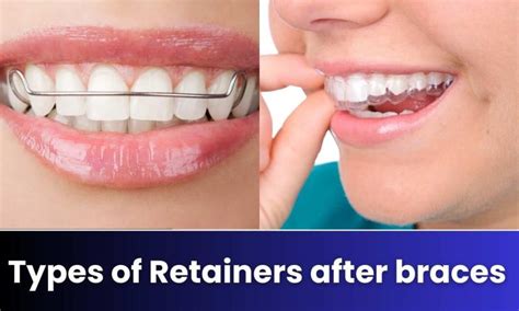 Types Of Retainers After Braces Health Dialogues