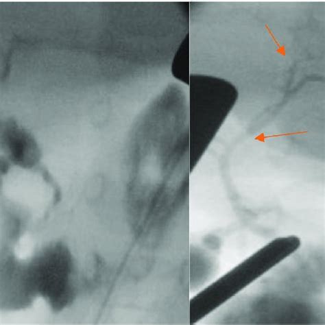 Intraoperative Cholangiogram A Cholangiogram Through The Gallbladder