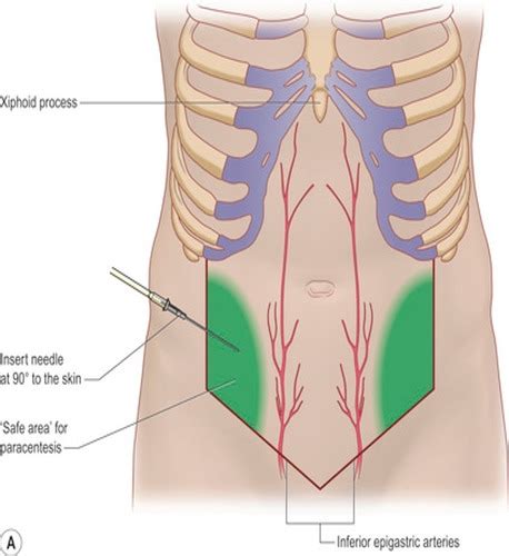 8 Abdominal Paracentesis Flashcards Quizlet