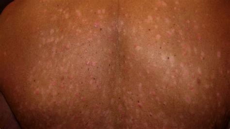 Why Do I Have White Spots On My Body That Won T Tangle