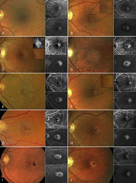 Clinical Findings And Corresponding Early Respective Upper Frame And