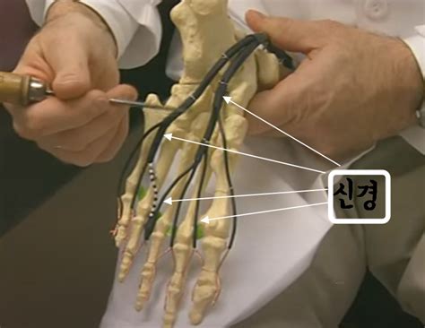 발바닥 통증 이중에 하나일겁니다 통풍 무지외반증 지간신경종 족저근막염 아킬레스건염 네이버 블로그