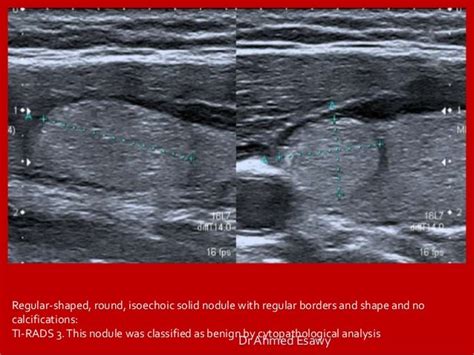 Tirads Thyroid Nodule Imaging Reporting And Data System Dr Ahmed E…