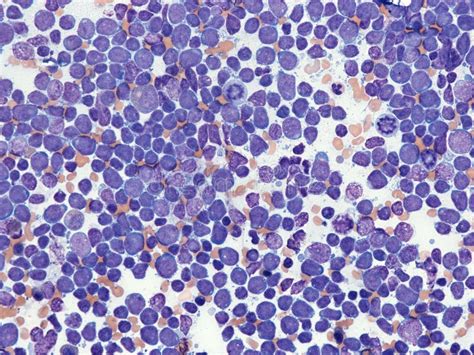 Ph Positive Acute Lymphoblastic Leukemia Stock Illustration