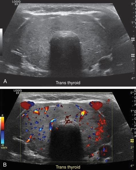 The Thyroid And Parathyroid Glands Clinical Tree