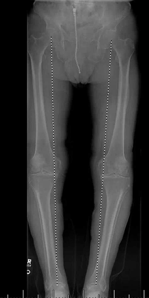 Preoperative Evaluation Of The Patient For Treatment With A Calipered