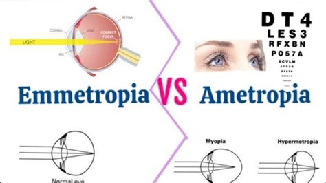 What Is Emmetropiaemmetropiya Kya Hai What Is Ametropia In