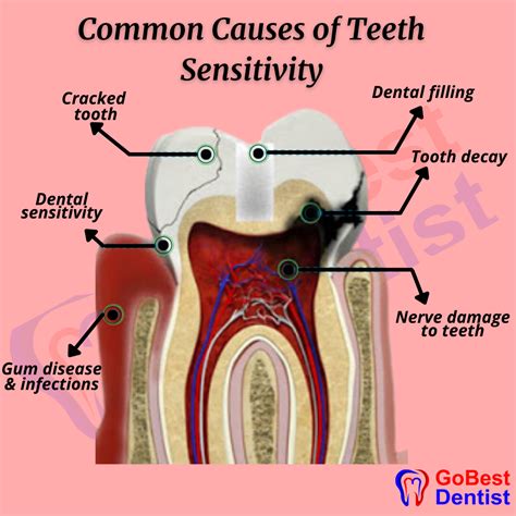 Teeth Sensitivity Treatment Gobest Dentist
