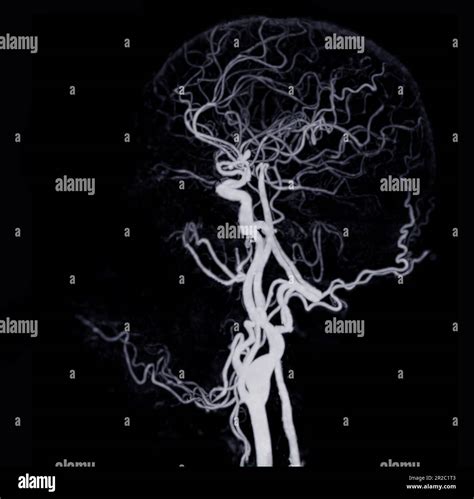 CT Angiography Of The Brain Or CTA Brain Showing Cerebral Artery Stock Photo Alamy