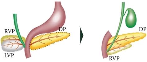Pancreatic Divisum The Operative Review Of Surgery