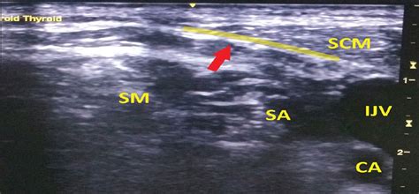 Ultrasound Guided Intermediate Cervical Plexus Block Added T The Indian Anaesthetists Forum