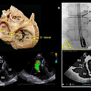 Right Ventricular RV Inflow Outflow Tract View As Seen In Download Scientific