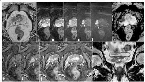 Prostate Multiparametric Magnetic Resonance Imaging Showing A Download Scientific Diagram