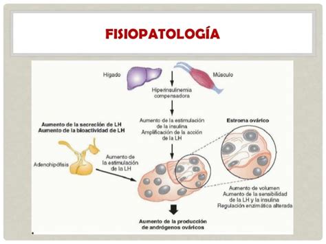 Sindrome De Ovario Poliquistico