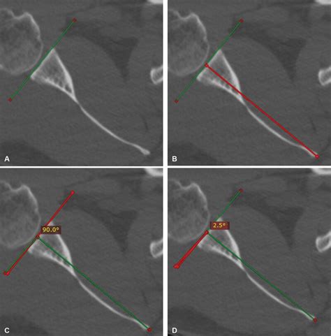 The Steps Involved In Measuring The Glenoid Version As Per The
