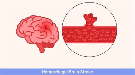 Brain Hemorrhagebrain Hemorrhage Symptoms Brain