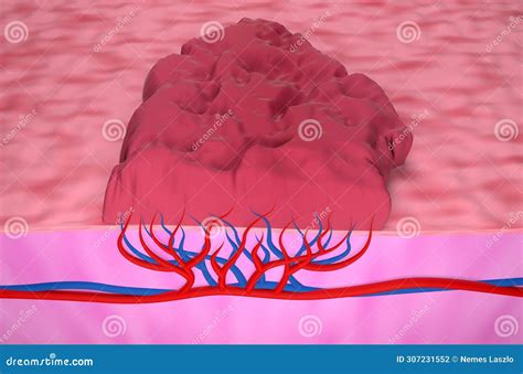 Hemangiomas Vector Illustration 351779266