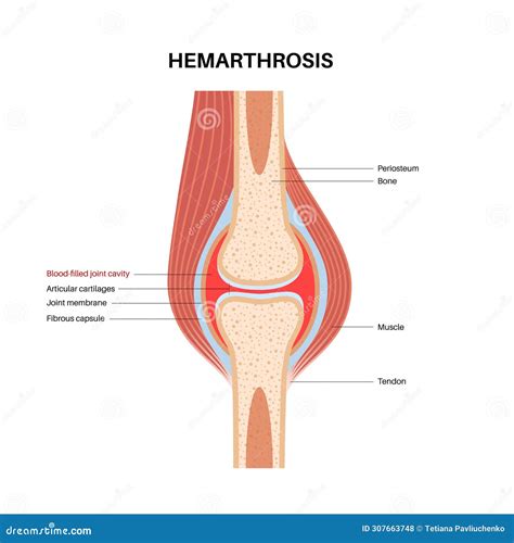 Hemarthrosis In The Synovial Joint Stock Vector Illustration Of Ligament Skeleton 307663748