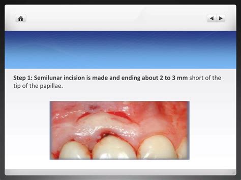 Root Coverage Procedures Pptx