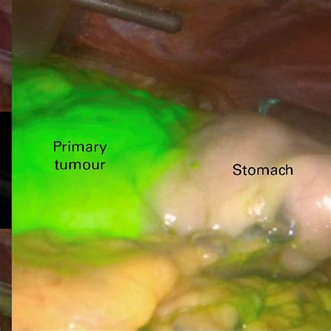 Mapping Of The Proximal Margin Of The Primary Tumour Download
