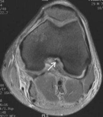 Anterior Cruciate Ligament Acl Mri Practice Essentials Anatomy