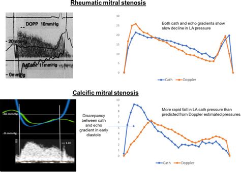 Insights From Simultaneous Echo And Cath Gradients In Rheumatic