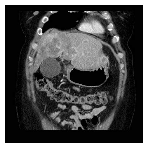 Ct Scan Of The Abdomen And Pelvis Download Scientific Diagram