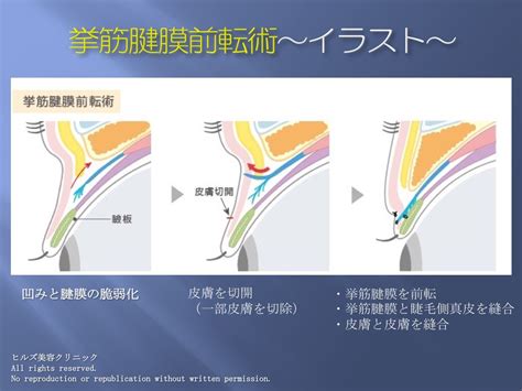 眼瞼下垂を伴うサンケンアイの治療〜挙筋腱膜前転術の解剖〜 ヒルズ美容ステーション