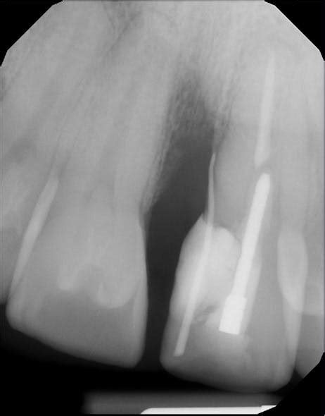 Dental Abscess Caused By Improper Dental Laser Use Perio Implant Advisory