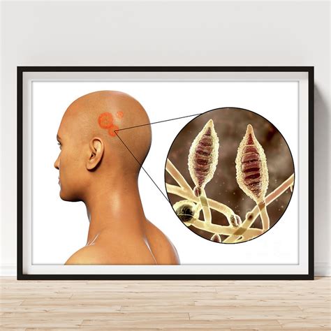 Ringworm 42 Poster By Science Photo Library Science Photo Gallery