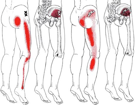 Gluteus Minimus Trigger Points Finding Relief