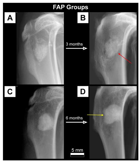 Lateral Radiographs Of A Defect In The Proximal Tibial Metaphysis Download Scientific Diagram