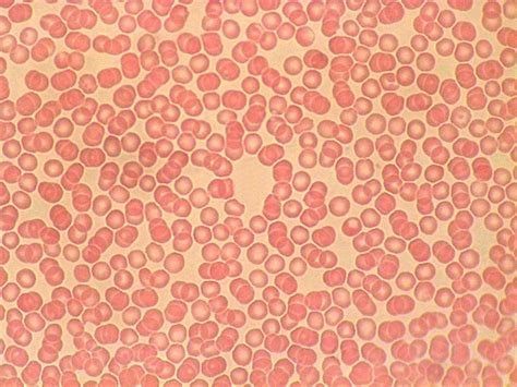 hematología 2017