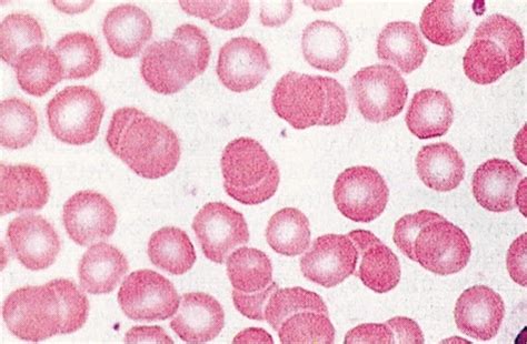 Microcitest Screening Anemie Microcitemiche Globuli Rossi Eritrociti