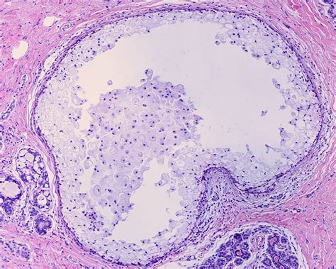 Duct Ectasia Can It Lead To Breast Cancer