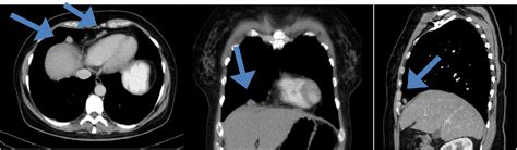 Figure 1 From Surgical Management Of Cardiophrenic Lymph Nodes In