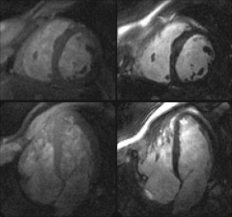 Cardiac Images Acquired At 1 5t Using Left Spiral Gradient Recalled