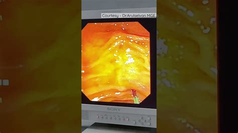 Ampulla Of Vater Cannulation Ercp Youtube