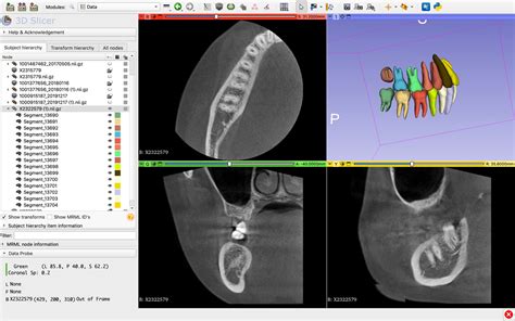 a problem of showing up the segmentation when loading support 3d