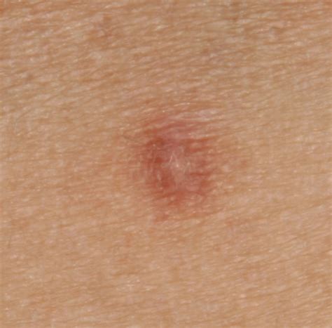 Skin Lesions That Are Not Cancer Cancerwalls