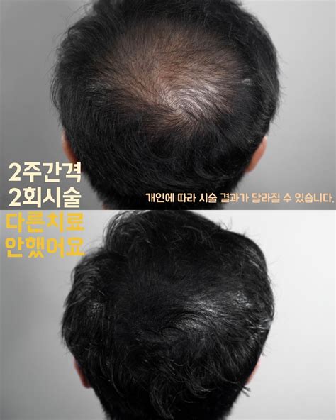 청담 다른 탈모치료 나 모발이식 수술을 받은 분 아닙니다 첫시술과 2주 후 리터치 만으로 생긴 변화입니다 배경색을 바꿔주기 위한 두피문신 시술을 확실하게 하는