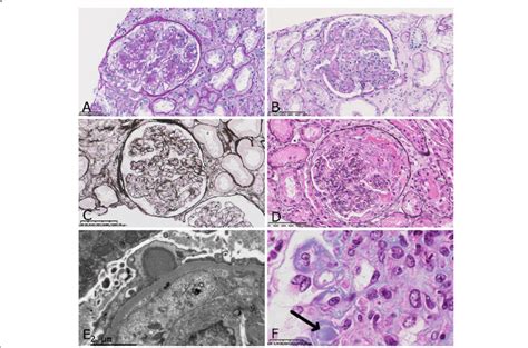 Microscopy A Mesangial With Endocapillary Proliferation Was The Most Download Scientific