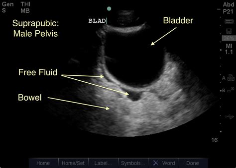 Point Of Care Ultrasound In Austere Environments Emergency Medicine