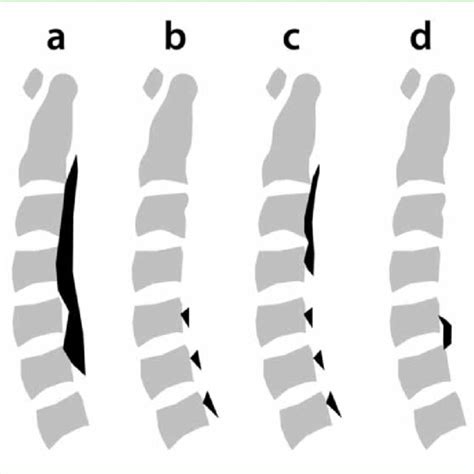 Morphological Classification Of The Ossification Of The Posterior
