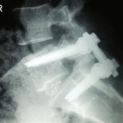 Entenda Tudo Sobre Pseudoartrose Da Coluna Dr Henrique Noronha