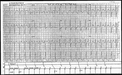Idiopathic Posterior Fascicular Ventricular Tachycardia Vt Manual