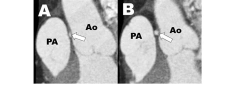 Ccta Images In Patients With Slit Like Ostium A And Normal Ostium Download Scientific Diagram