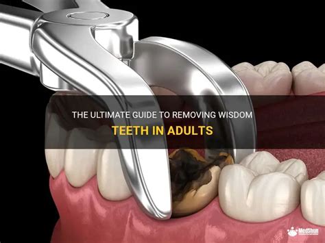 The Ultimate Guide To Removing Wisdom Teeth In Adults Medshun